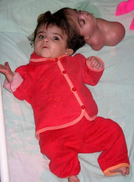 Conheça a história de Manar Maged, a criança que nasceu com duas cabeças