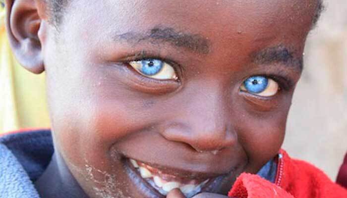 Albinismo ocular: uma condição genética que pode trazer problemas