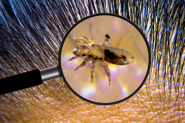 Como prevenir e combater piolho em crianças e adultos