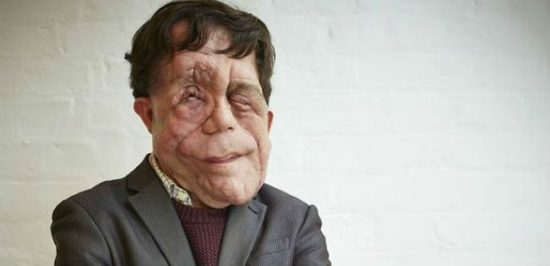 Britânico desfigurado por tumores relata cotidiano de agressões