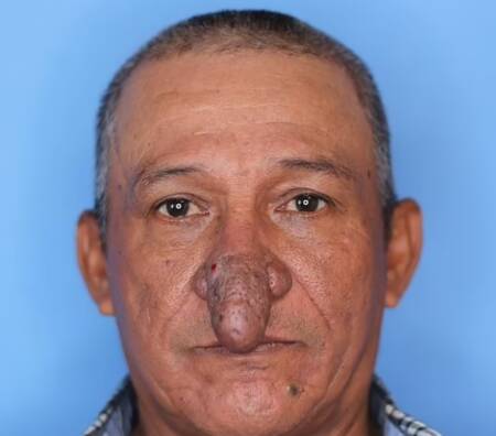 Homem com inflamação crônica que deforma o nariz faz rinoplastia