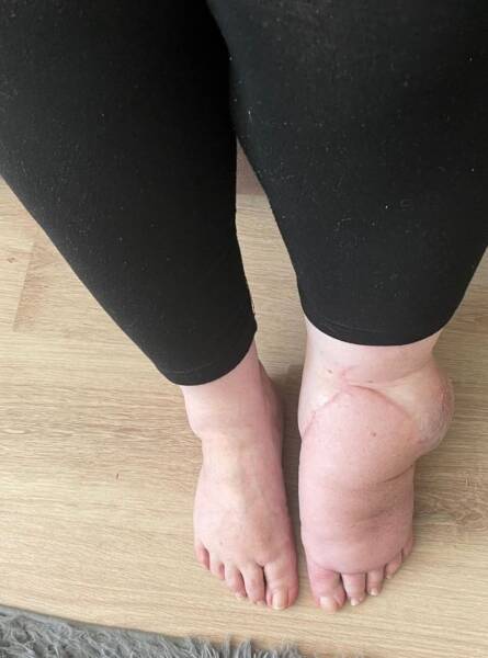 Mulher descobre que inchaço no pé é câncer e pode ter parte do corpo ...