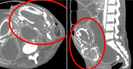 Entenda o caso de mulher que morreu com feto calcificado