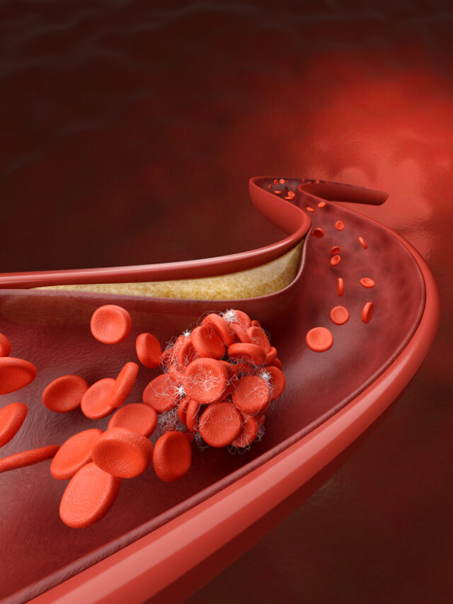 Como controlar o colesterol ruim? - Catraca Livre